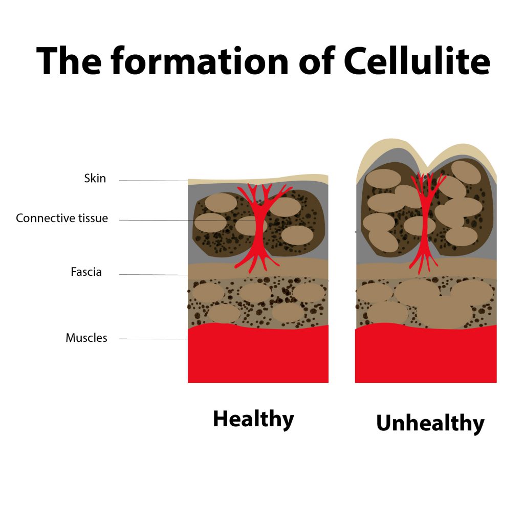 Put cellulite in its place: OFF your thighs - Easy Health Options®