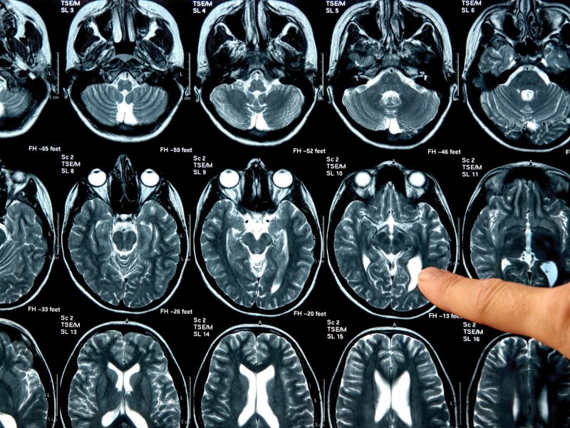 Reversing age-related brain shrinkage is easier than you think - Easy ...