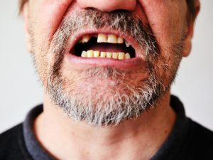 Why this disease sign makes your teeth fall out - Easy Health Options®