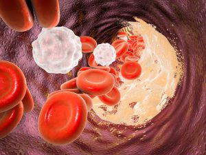 Are greasy, bacterial bugs clogging your arteries? - Easy Health Options®