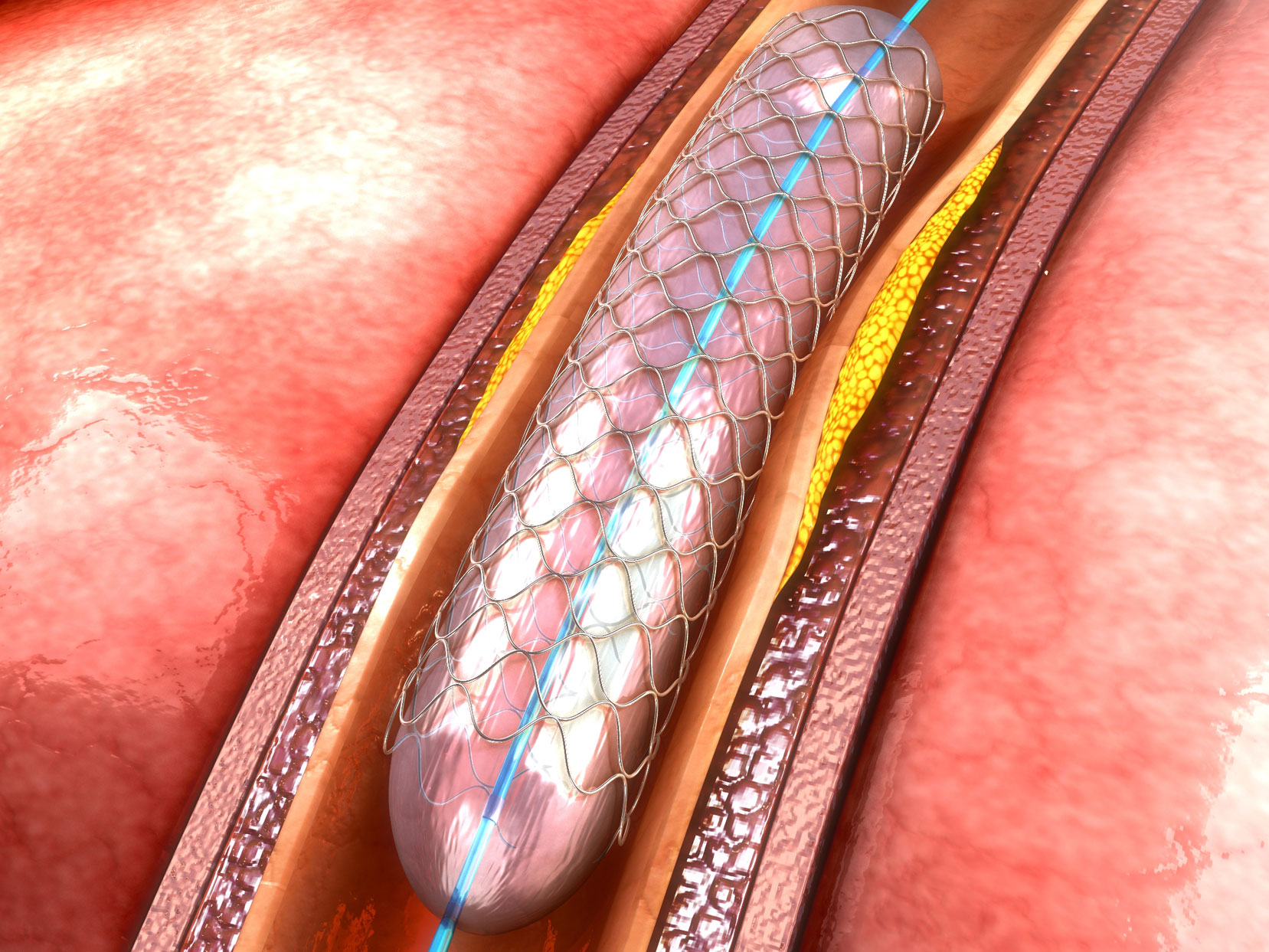 Stents Don t Prevent Future Heart Attakcs Easy Health Options Stents Don t Prevent Future Heart Attakcs Easy Health Options