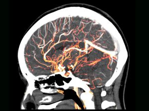 How inflammation makes your brain impulsive - Easy Health Options®